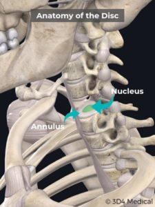 How to Know if you have a Neck Disc Herniation - Geelong Osteopaths